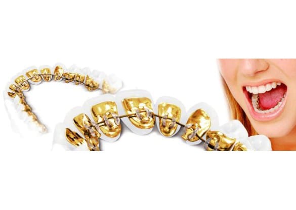 Vaughan Inside Braces | Lingual Brace | Woodbridge Ontario